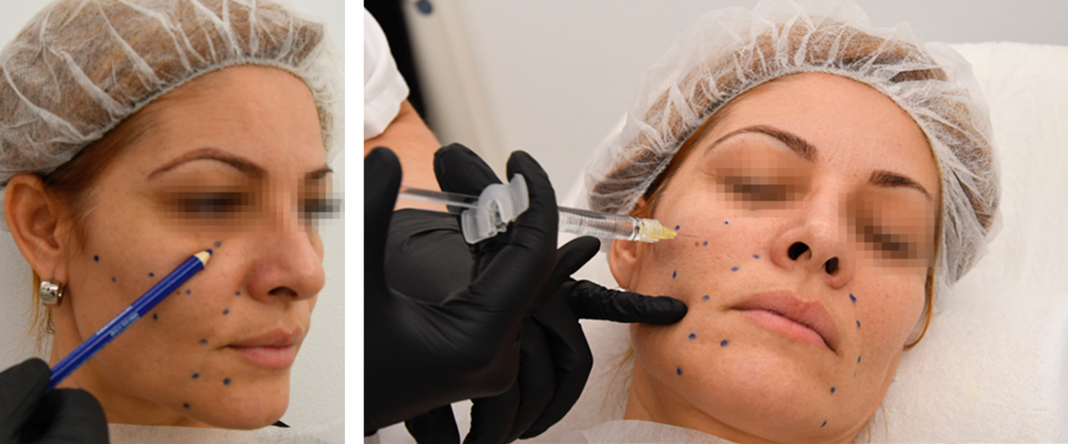 RRS® HA Long Lasting - Skin Tech Pharma Group BNLX